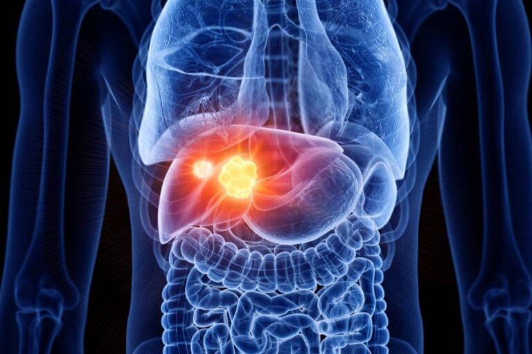Liver Cancer Surgeon in Chennai | Dr. S. Srivatsan Gurumurthy - Expert Care