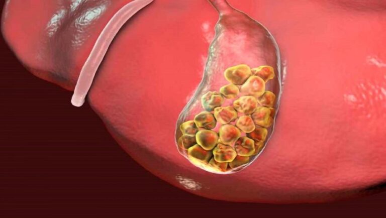 Gallstone Formation and Treatment: Insights by Dr. Srivatsan Gurumurthy ...