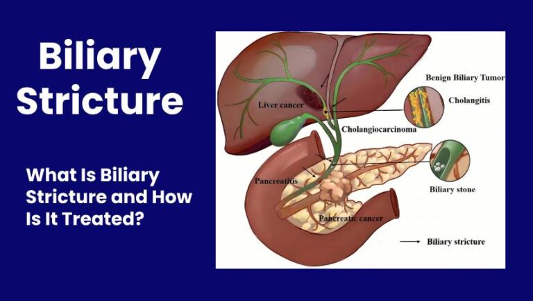 Biliary Stricture Treatment in Chennai | Dr. Srivatsan Gurumurthy